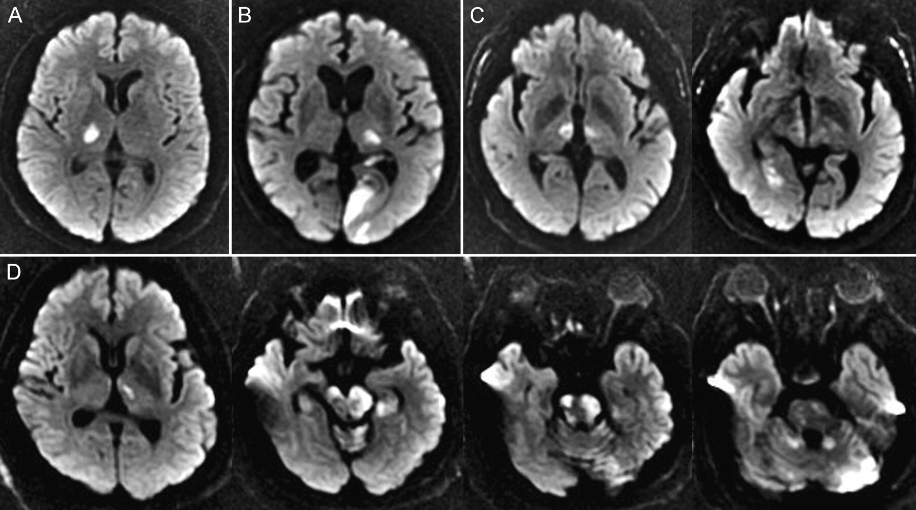 Posterior Choroidal Artery Stroke Mri