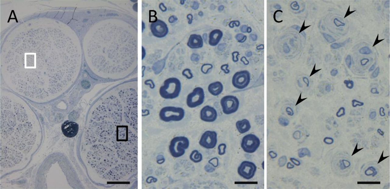 Clinicopathological characteristics of subtypes of chronic inflammatory ...