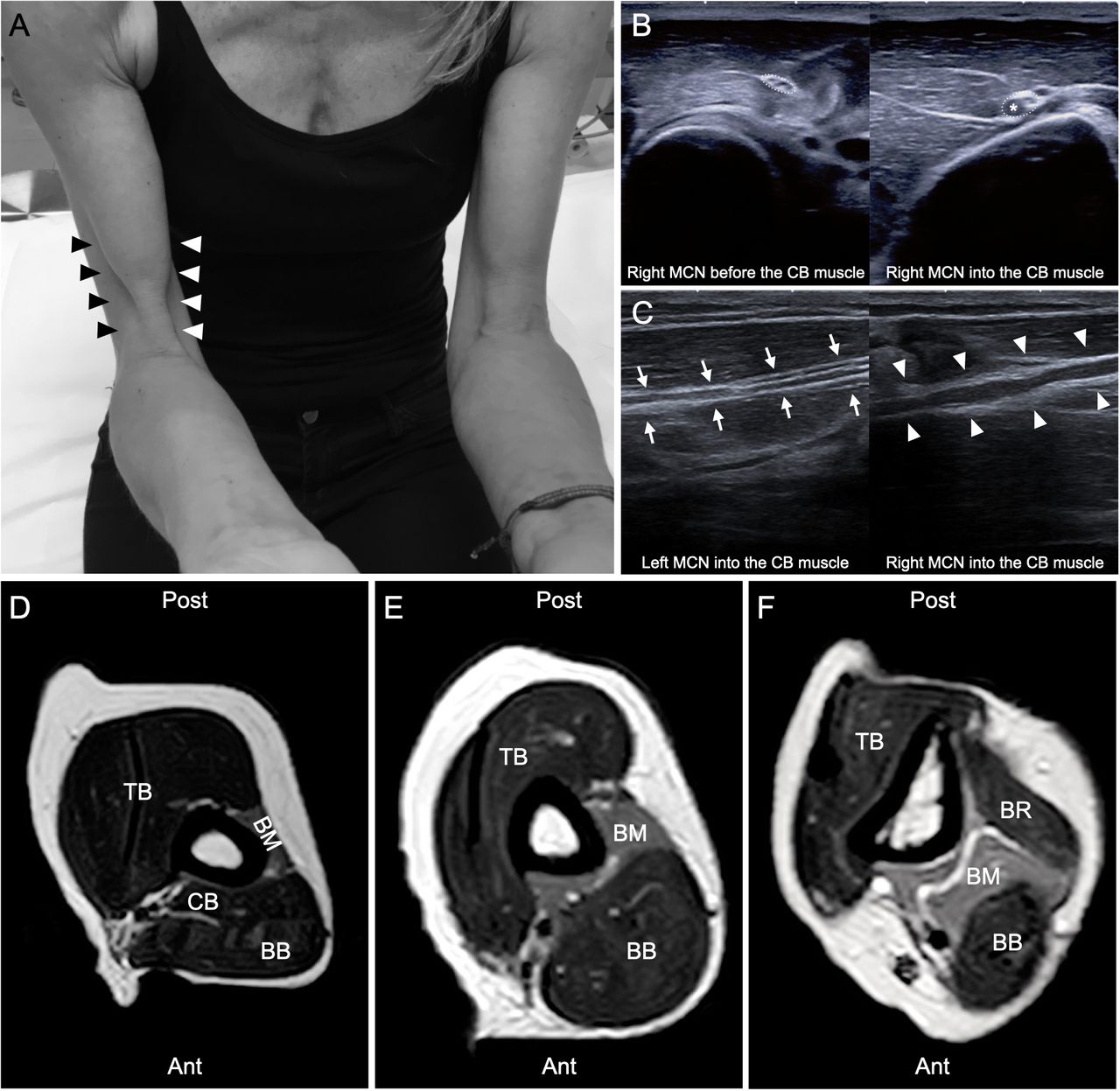 Selective atrophy of the brachialis muscle in neuralgic amyotrophy ...