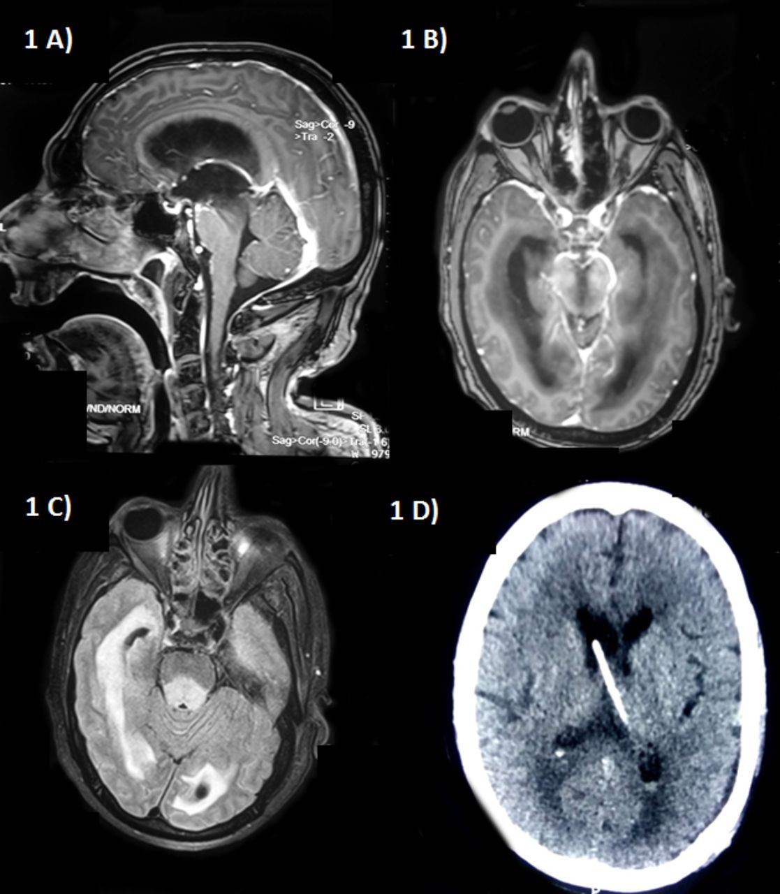 Listeria rhombencephalitis with hydrocephalus | Journal of Neurology ...