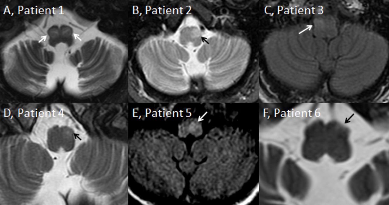 Association between paraneoplastic rhombencephalitis and hypertrophic ...