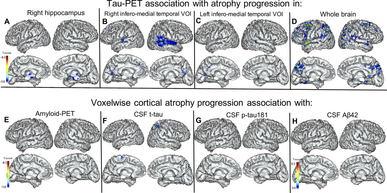 Tau-PET imaging predicts cognitive decline and brain atrophy ...