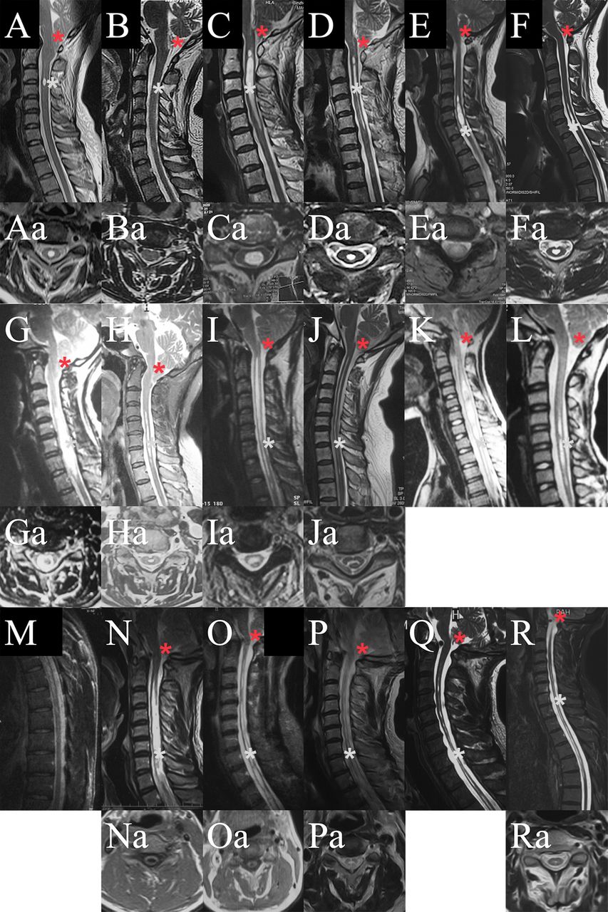 Natural history of Chiari I malformation-syringomyelia: longitudinal ...